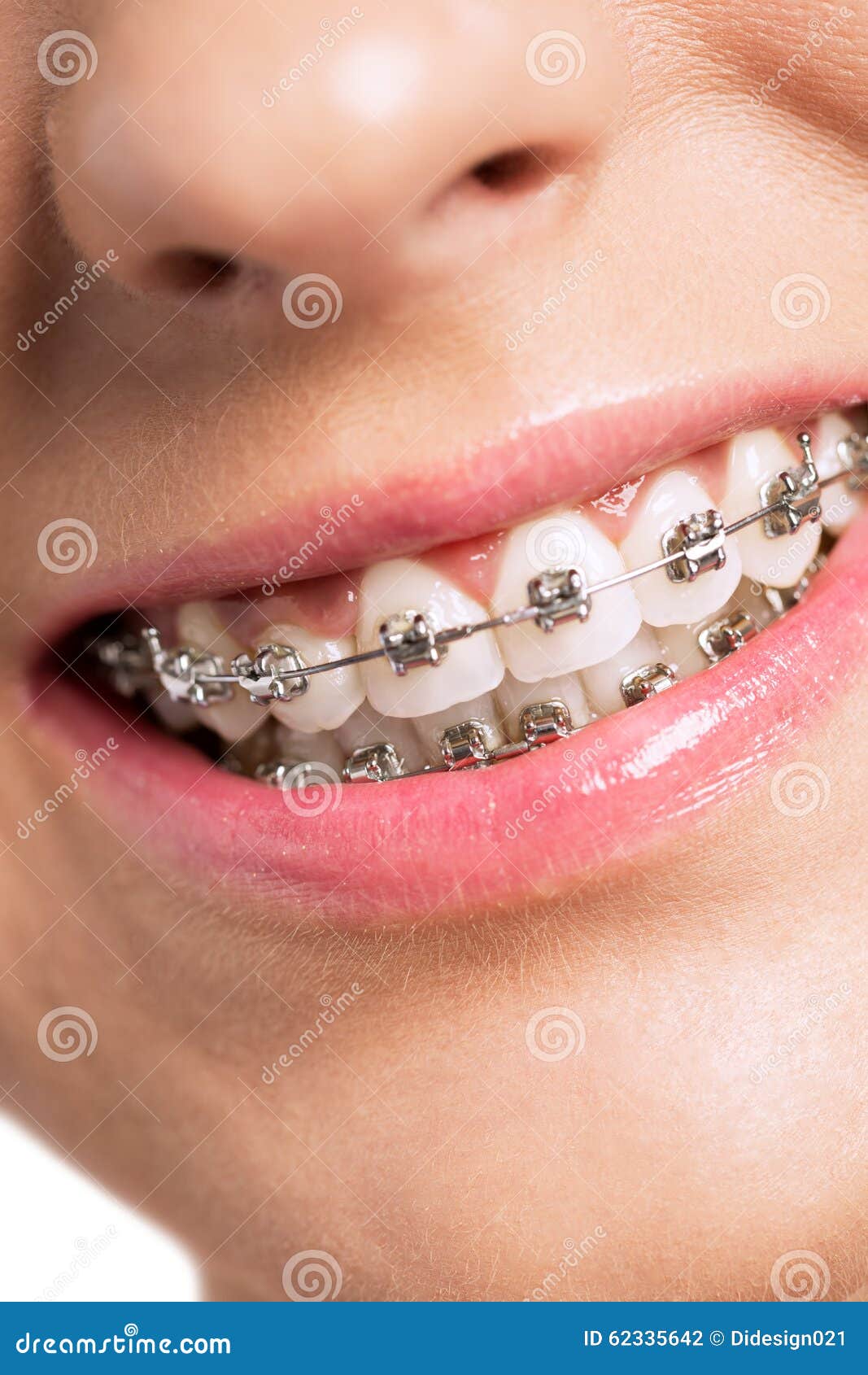 Happy Smiling Healty Woman with Braces Stock Photo - Image of brackets ...