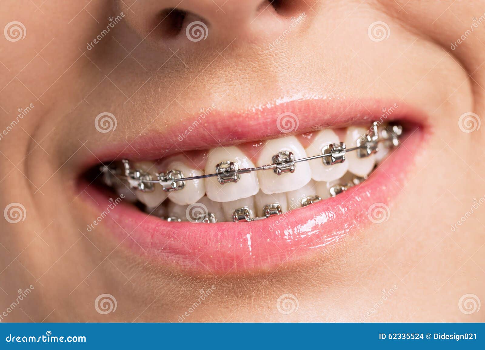 Happy Success Smile with Perfect Teeth and Braces Stock Photo - Image ...