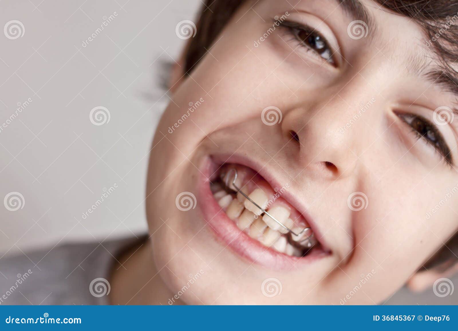 Happy teen with Braces stock image. Image of healthy - 36845367