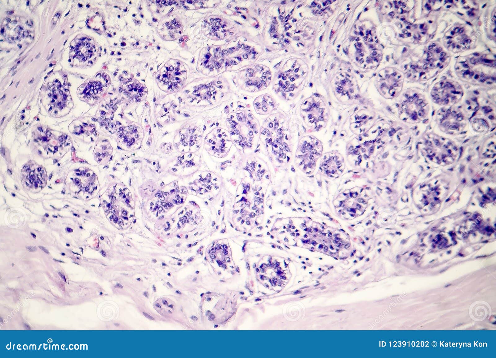 Hard Breast Cancer, Light Micrograph Stock Photo - Image of cancer ...