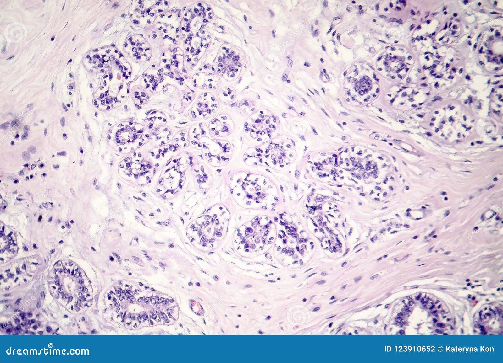 Hard Breast Cancer, Light Micrograph Stock Photo - Image of microscope ...