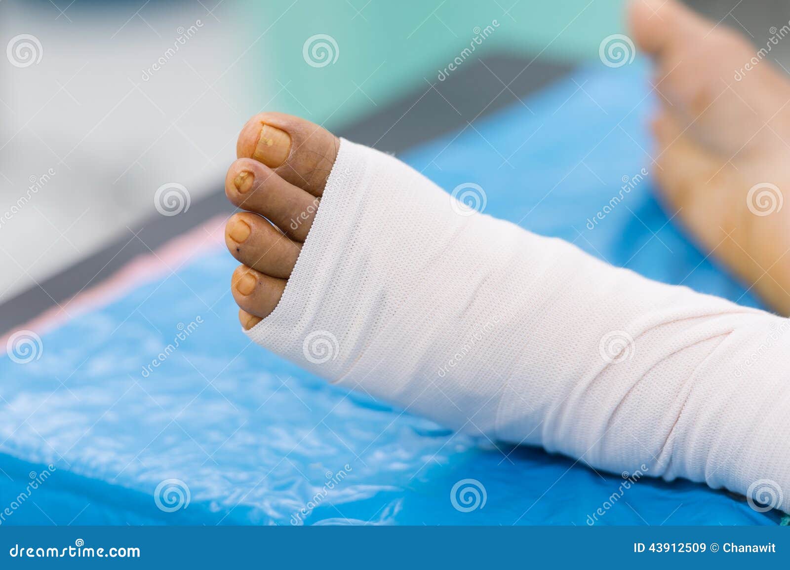 After Harvest Greater Saphenous Vein Stock Image - Image of internal ...