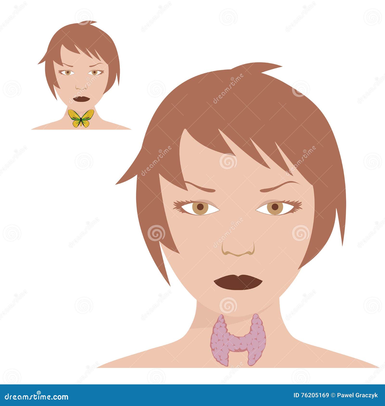 Hashimotos Disease Cartoon Vector | CartoonDealer.com #76205169