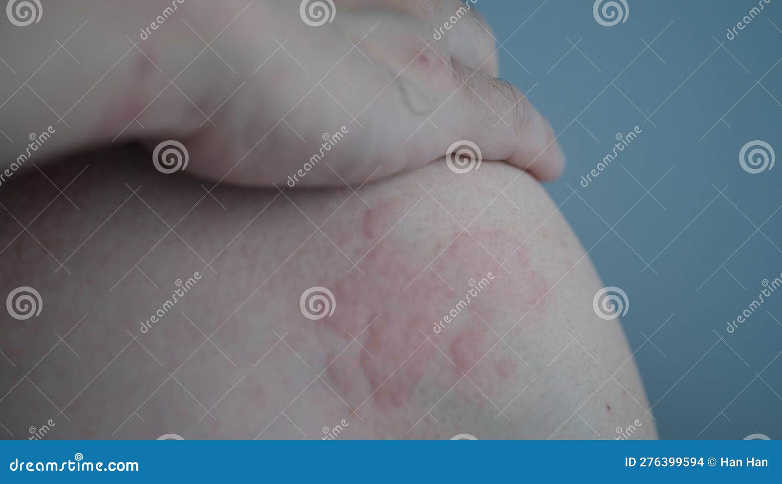 Hautstruktur Mit Schwerer Urtikaria Oder Nesselsucht Oder Kaligata Auf ...