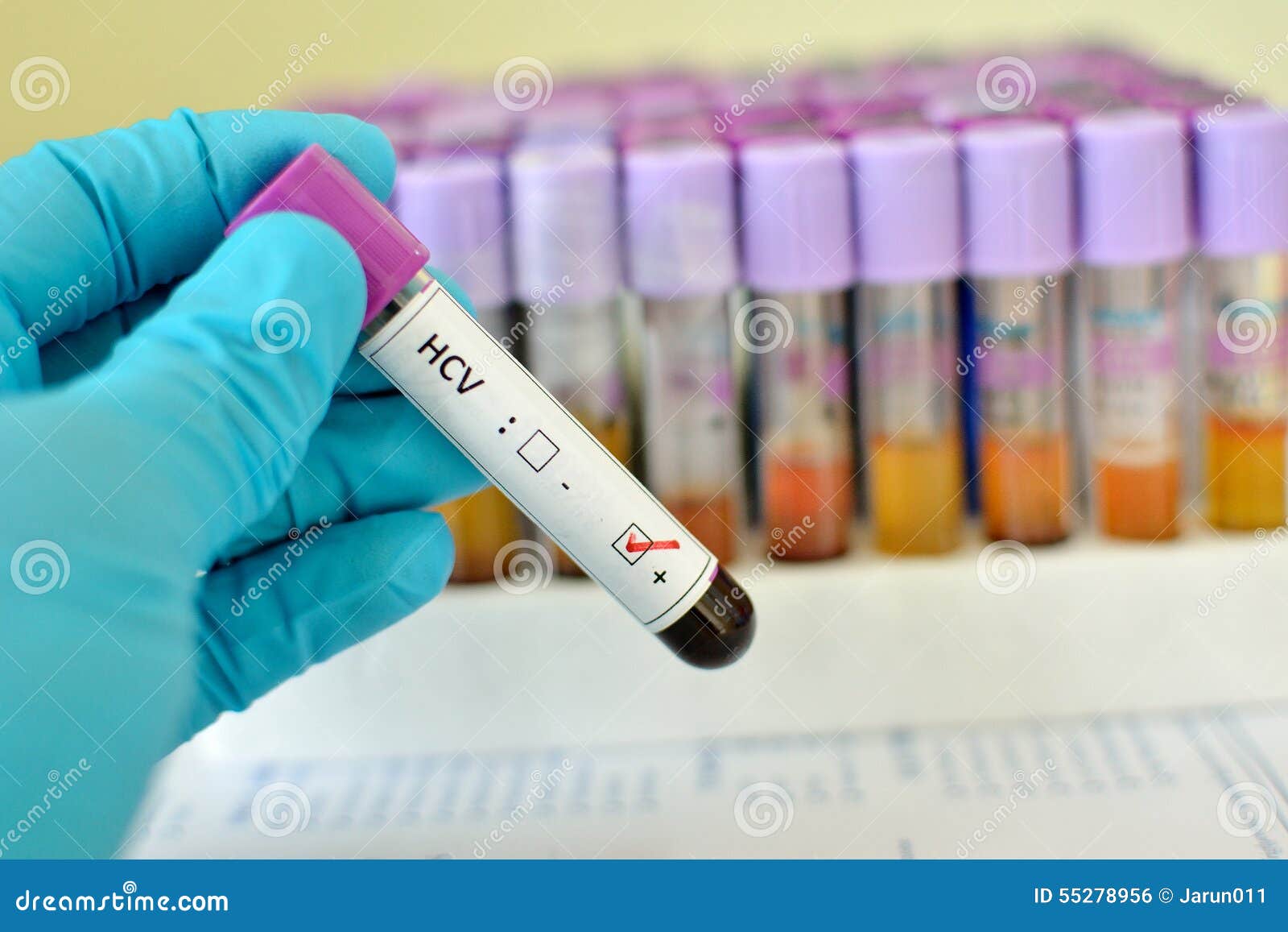 HCV positive stock photo. Image of organism, virus, healthcare - 55278956