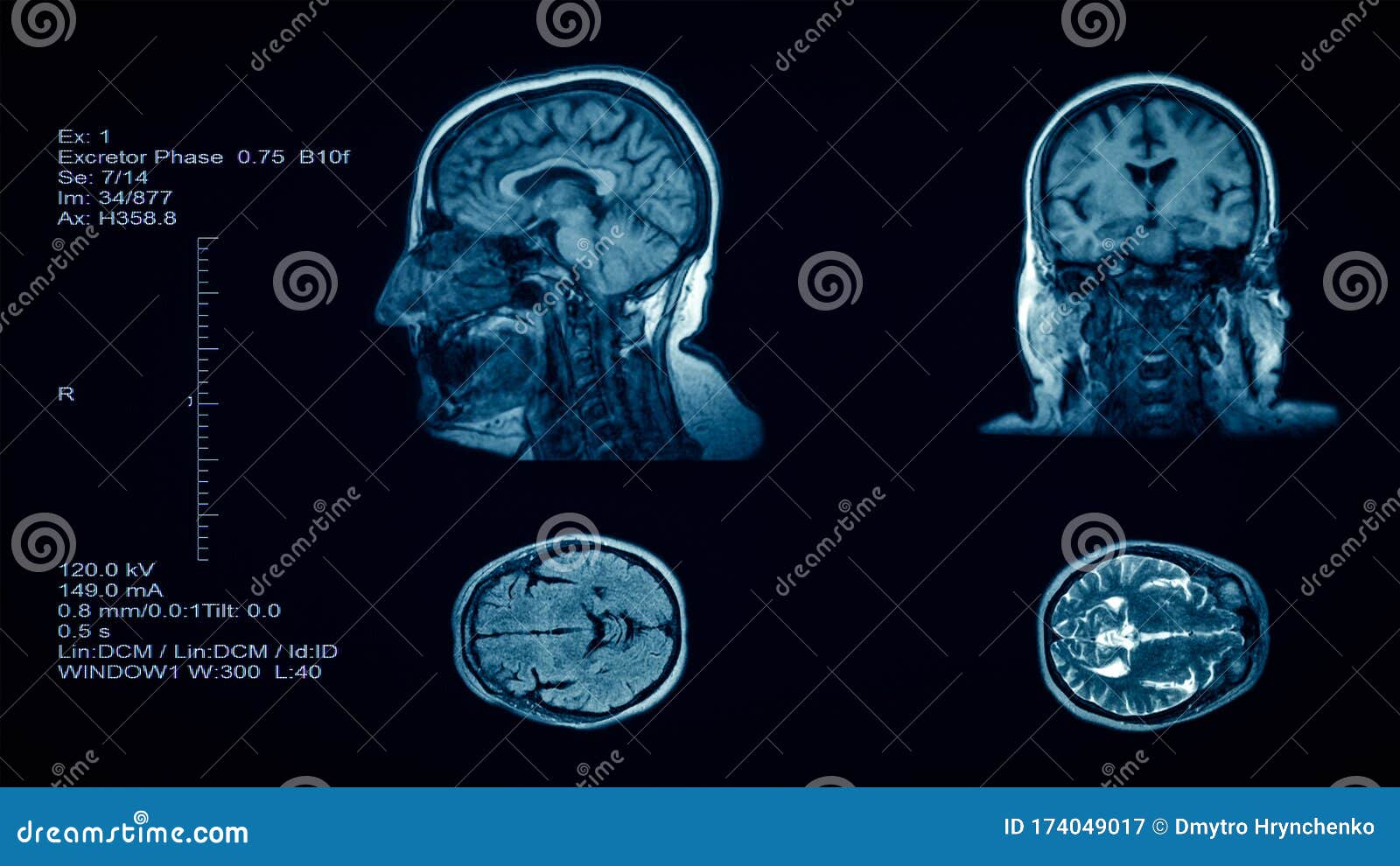 Head And Brain Computer Tomography Result Visualization. Four ...