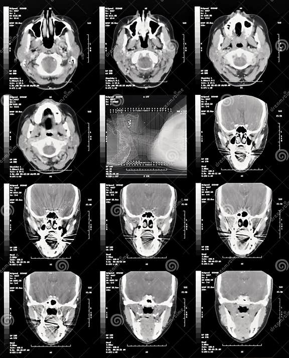 Head CAT Scan stock image. Image of medical, computerized - 6545811