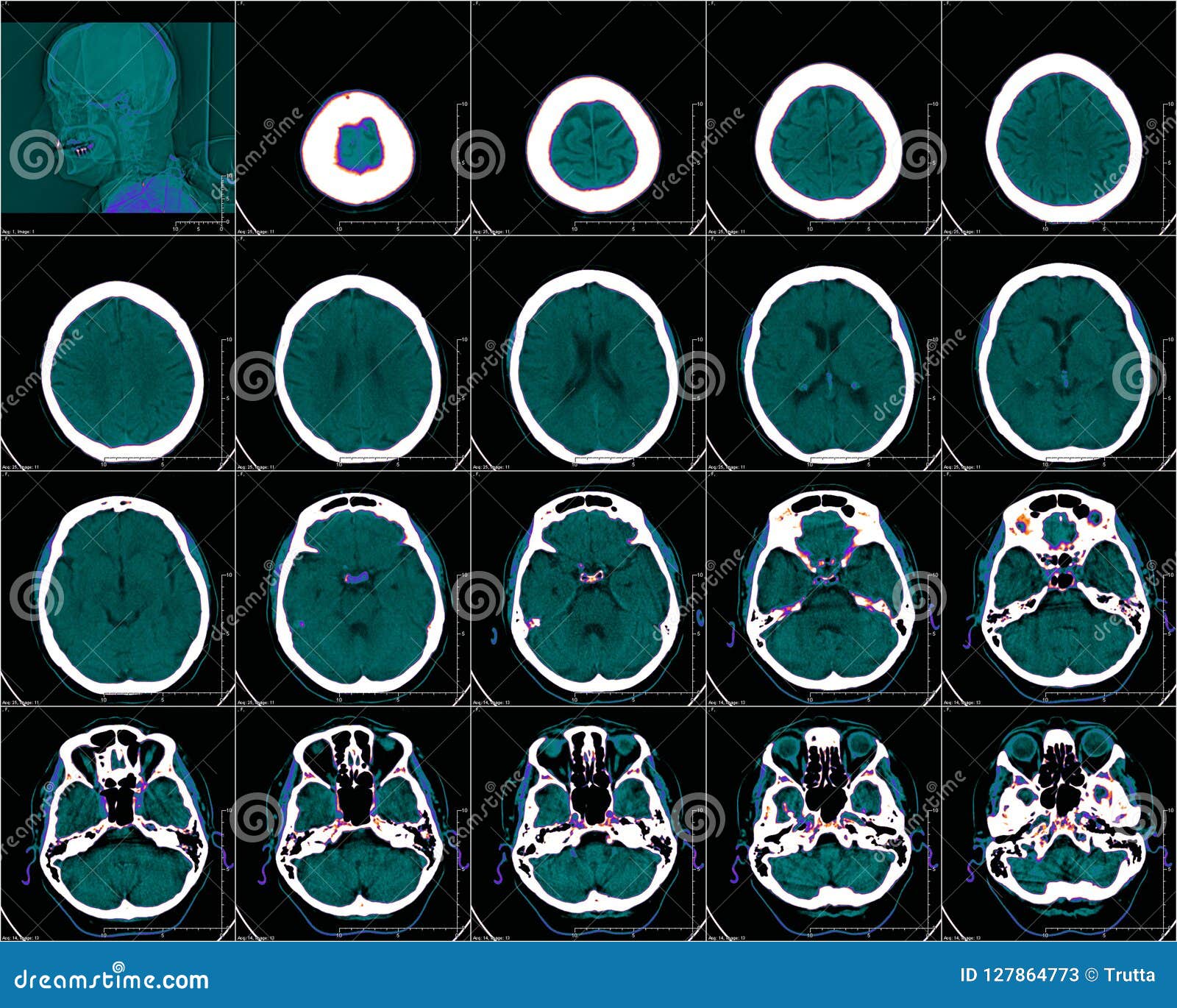 CT head image stock image. Image of illness, xray, head - 127864773