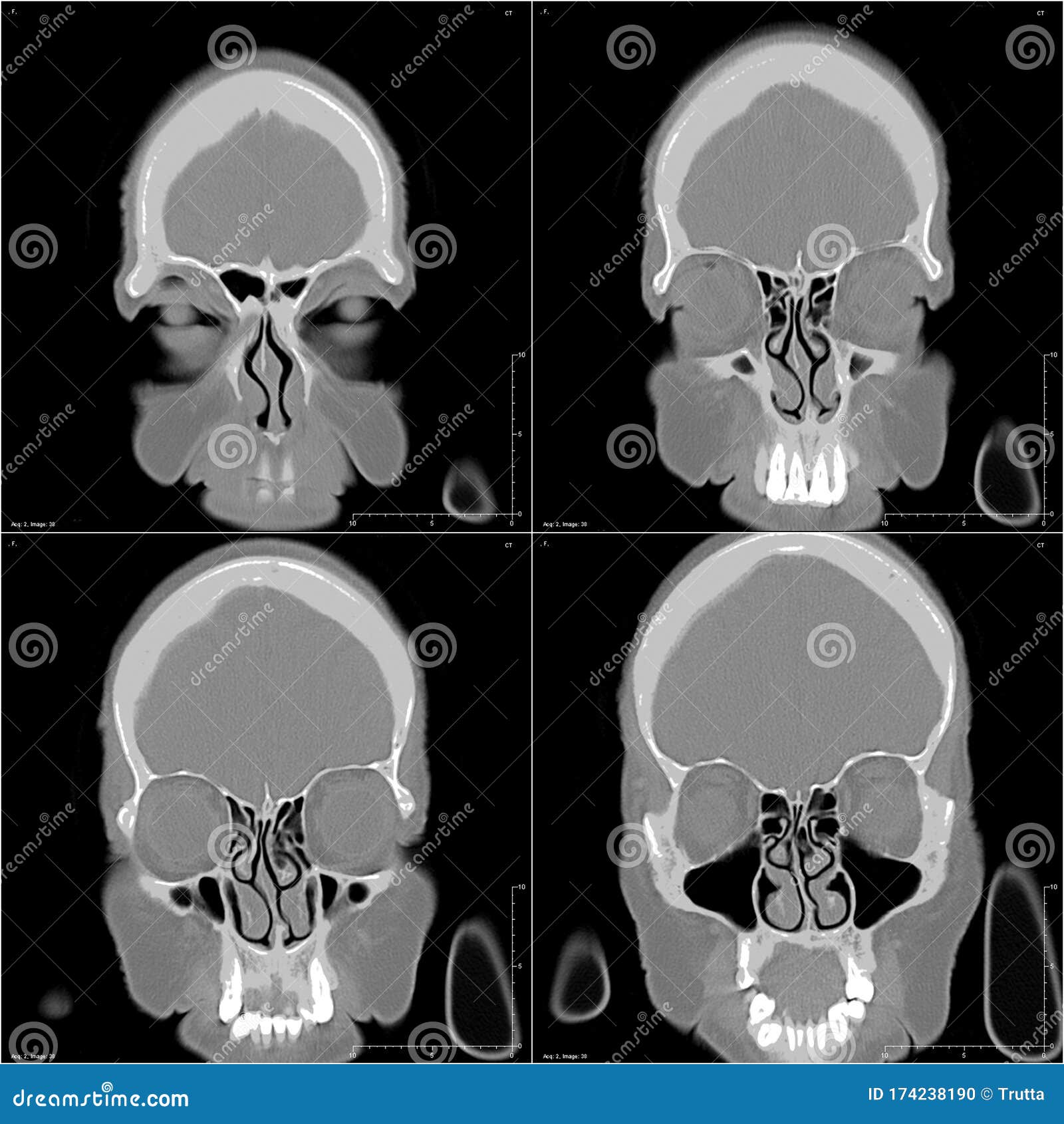 CT head image stock photo. Image of xray, medicine, anatomy - 174238190