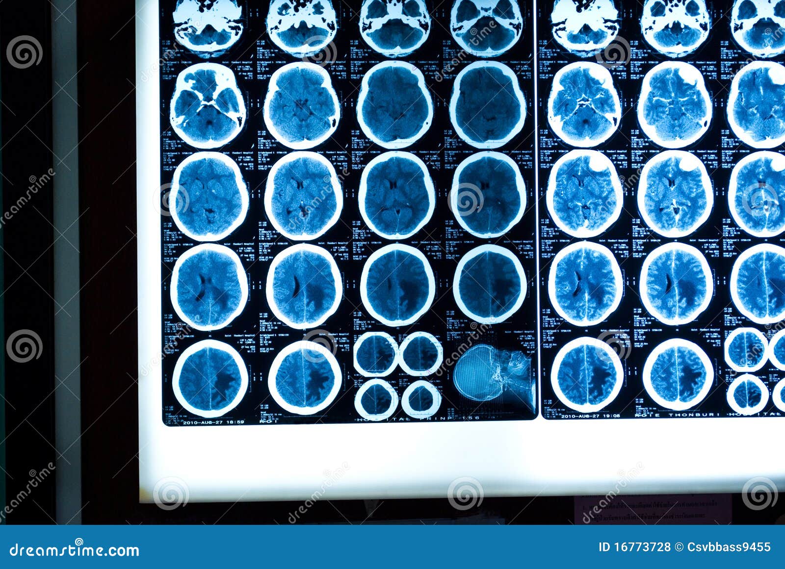 Head CT stock photo. Image of diagnosis, industry, disease - 16773728