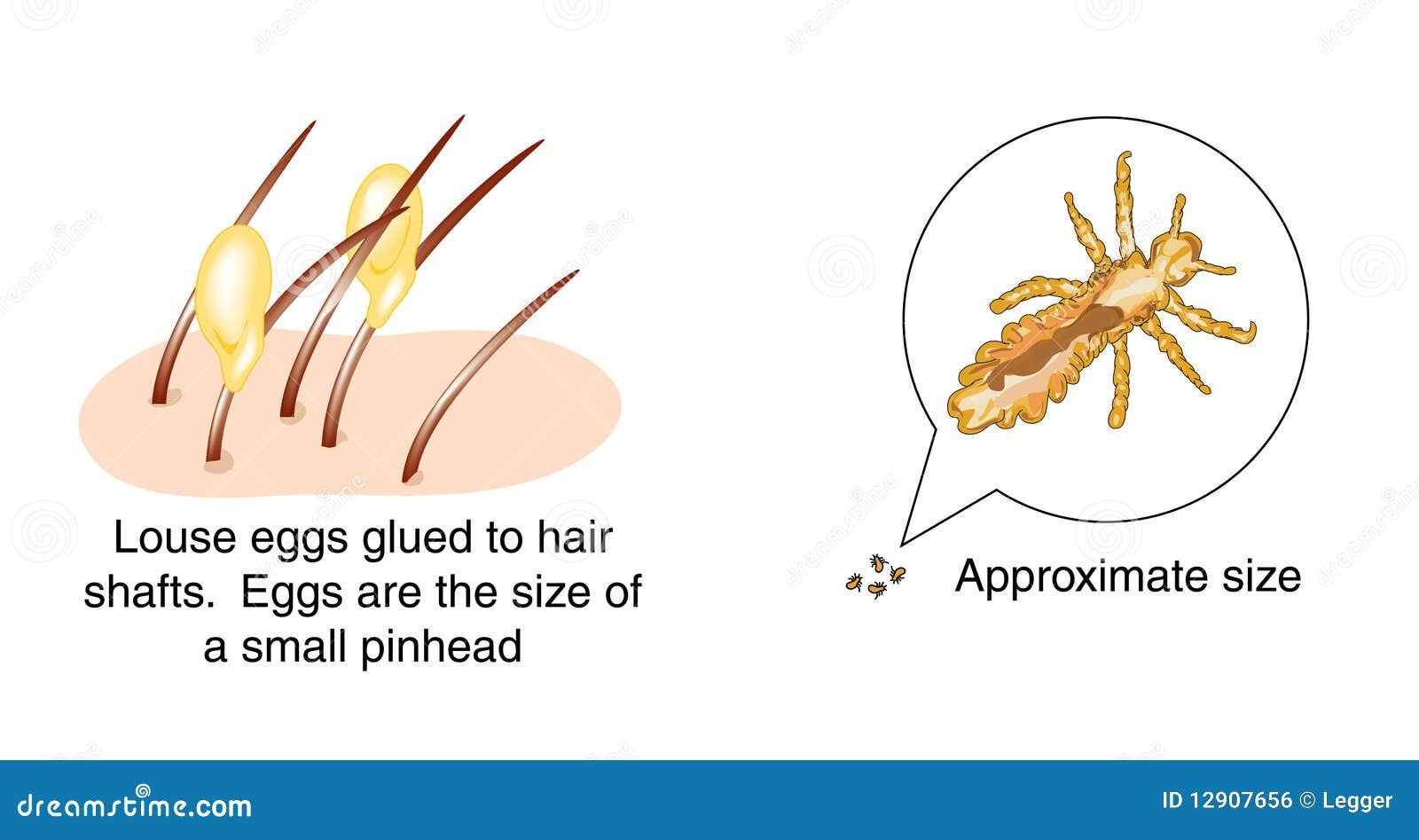 Head Louse Life Cycle Stock Photo | CartoonDealer.com #46581414