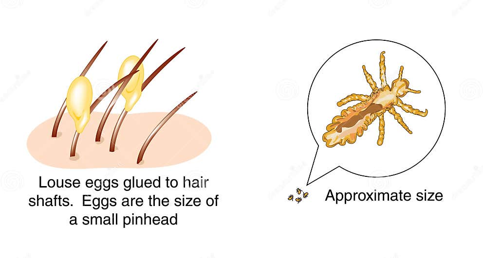 Head louse stock vector. Illustration of shaft, skin - 12907656