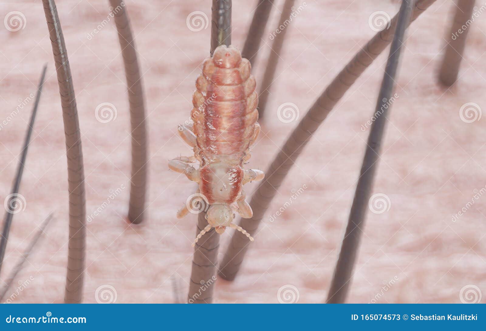 A head louse stock illustration. Illustration of dermatology - 165074573