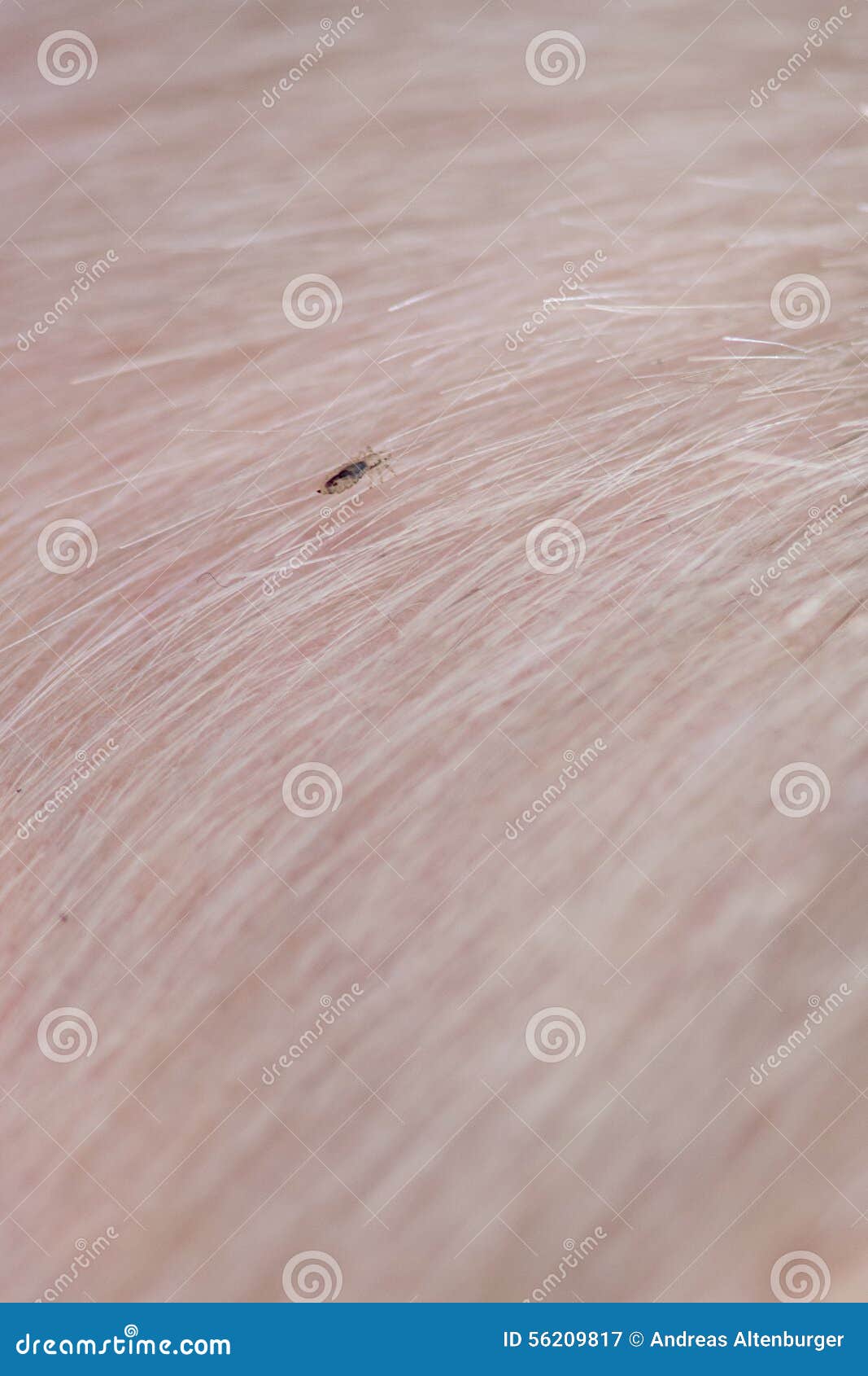 Head louse on head stock image. Image of pediculosis - 56209817