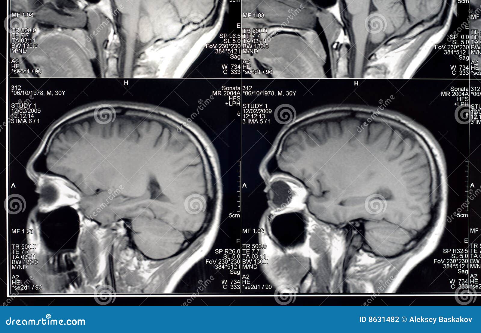 Head Magnetic Resonance Image Stock Photo - Image of healthcare ...