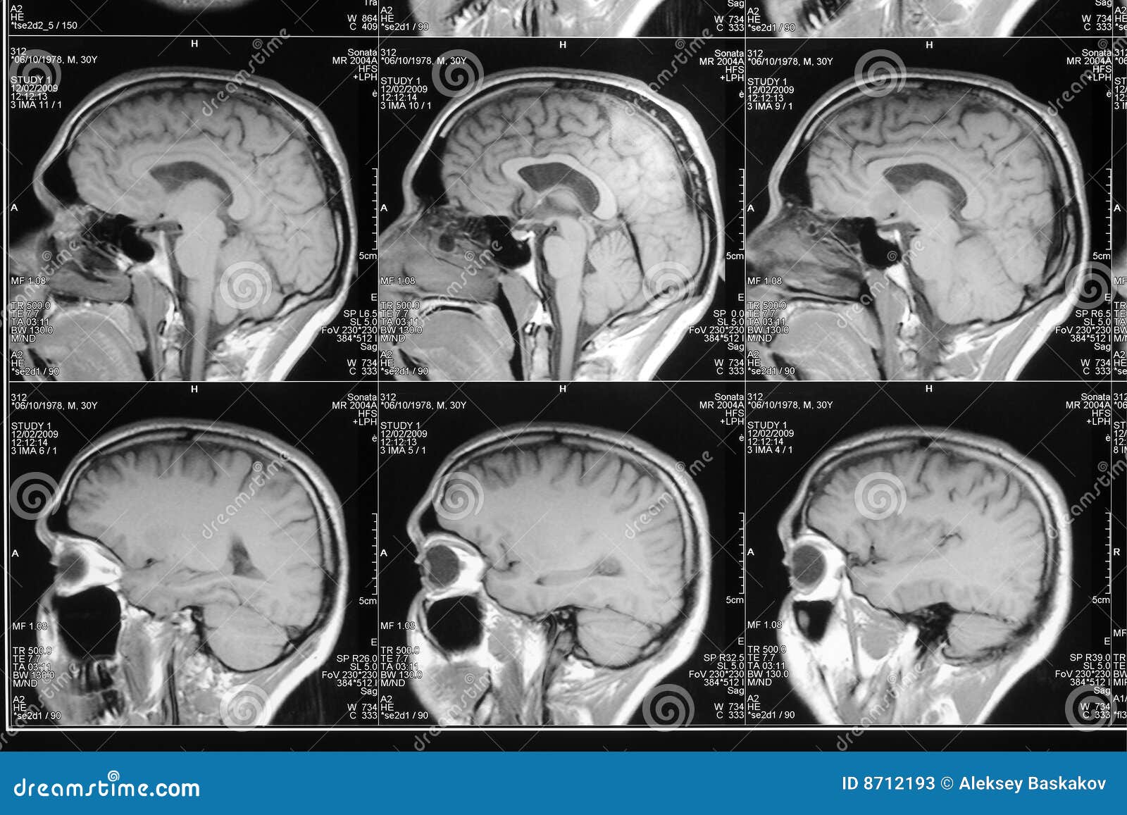 Head Magnetic Resonance Image Stock Image - Image of inside, research ...