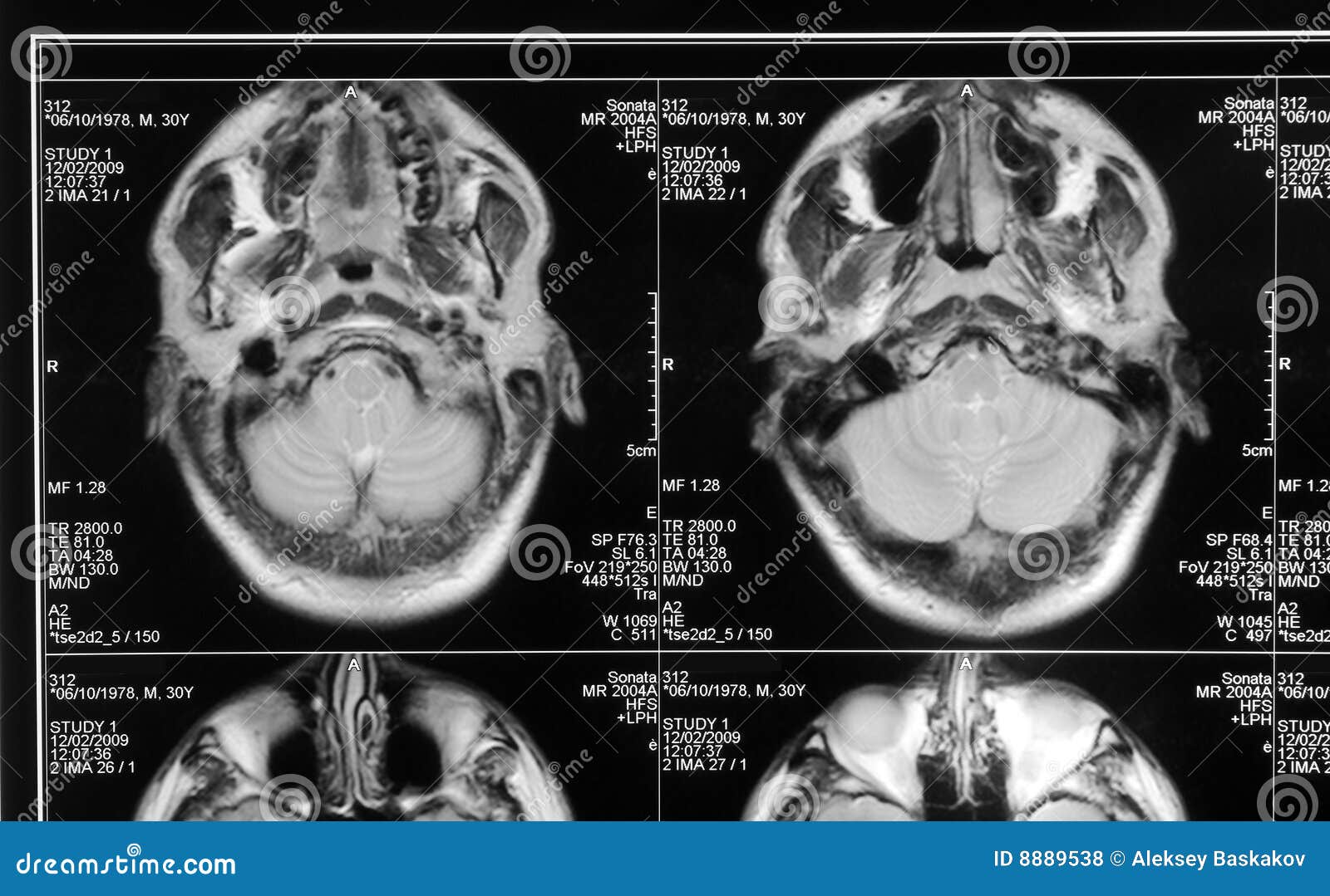 Head Magnetic Resonance Image Stock Photo - Image of anatomy, film: 8889538