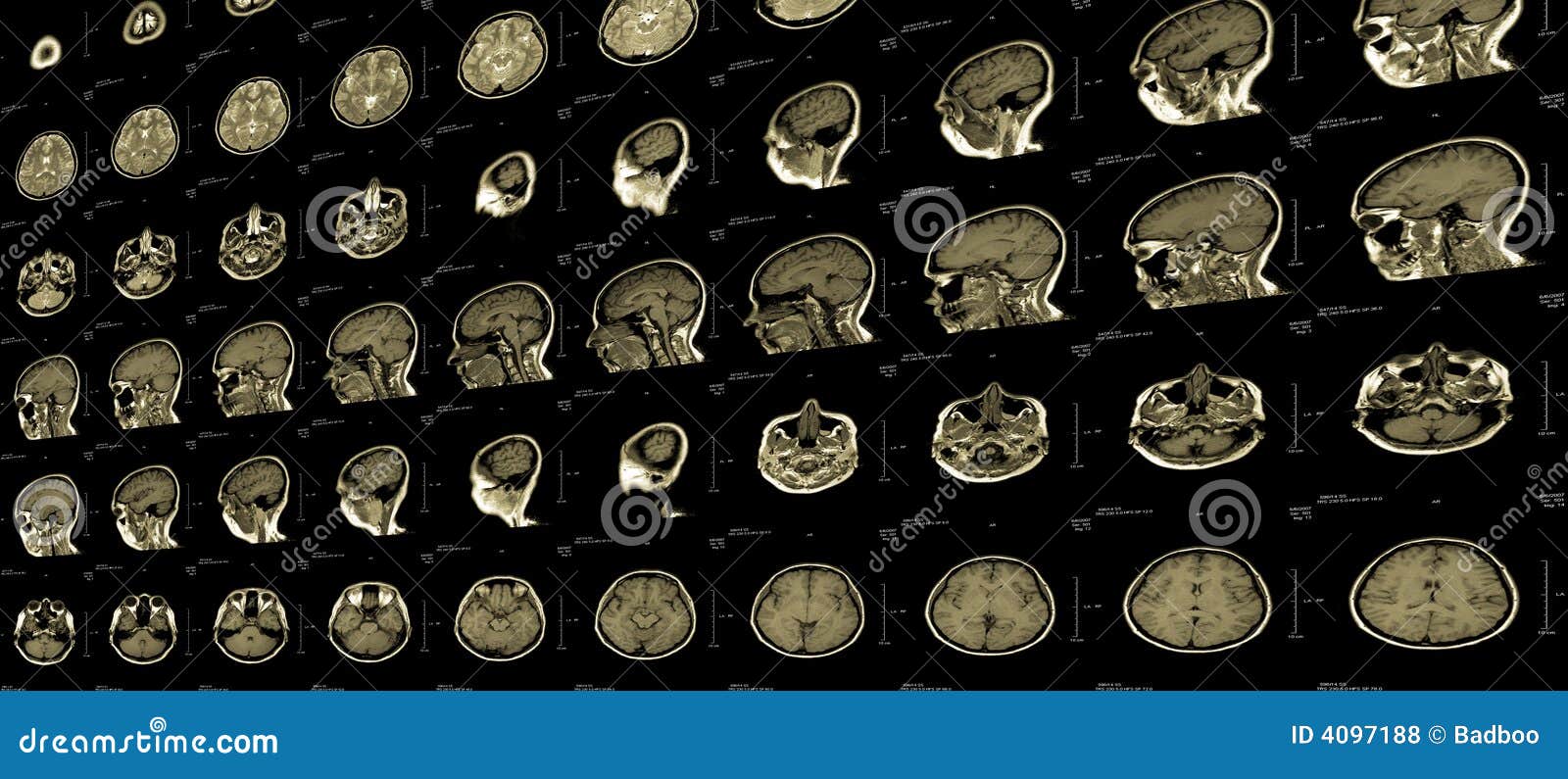 Head MRI stock photo. Image of disease, imaging, equipment - 4097188