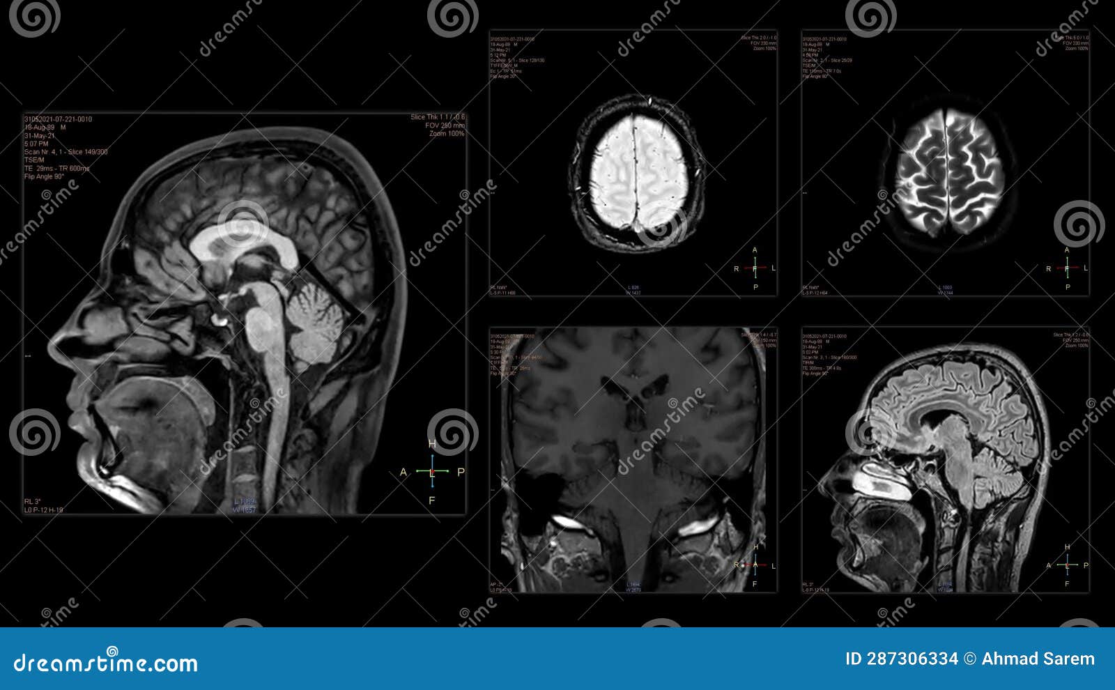 Head MRI Scan from Different Angles Stock Footage - Video of face ...