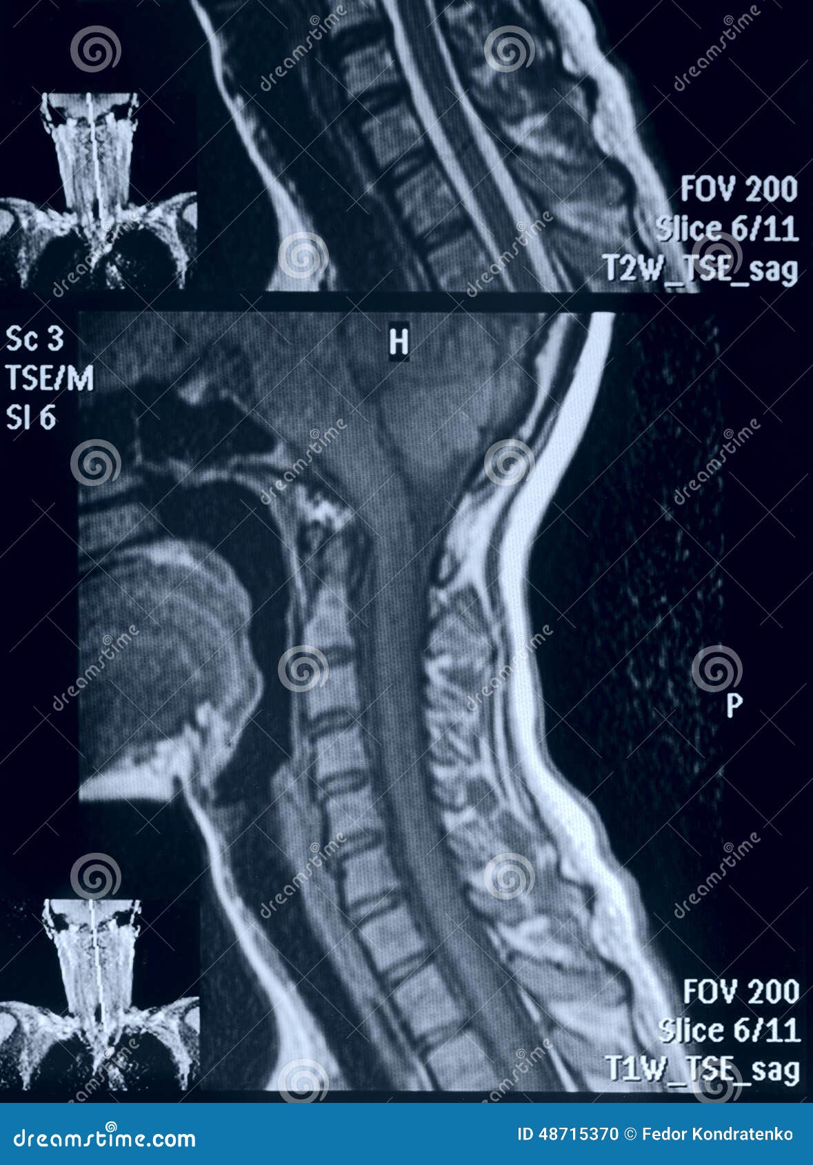 Head and Neck MRI Scan, Anonymized Stock Photo - Image of head, cord ...