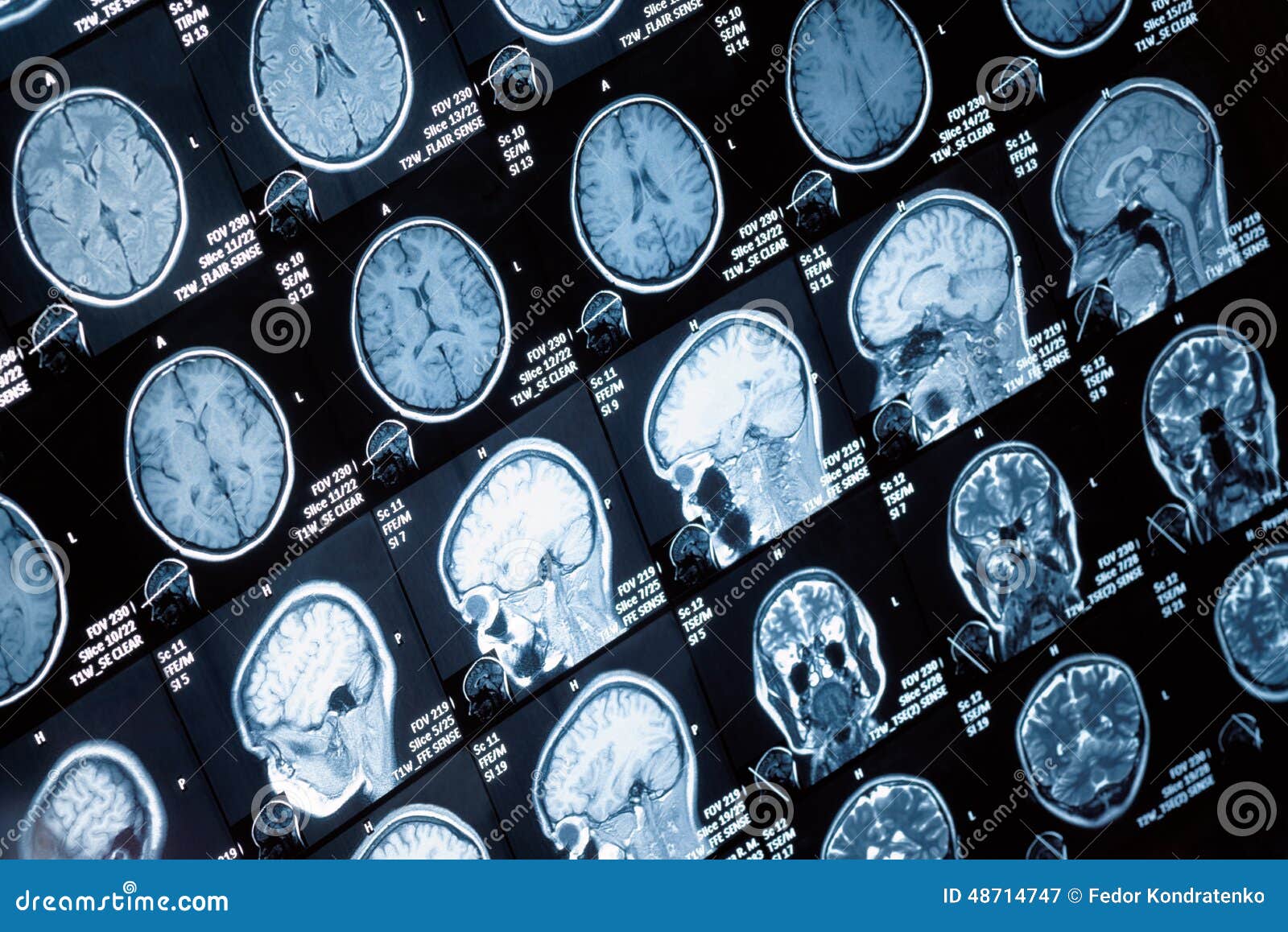 Head and Neck MRI Scan, Anonymized Stock Image - Image of health, black ...