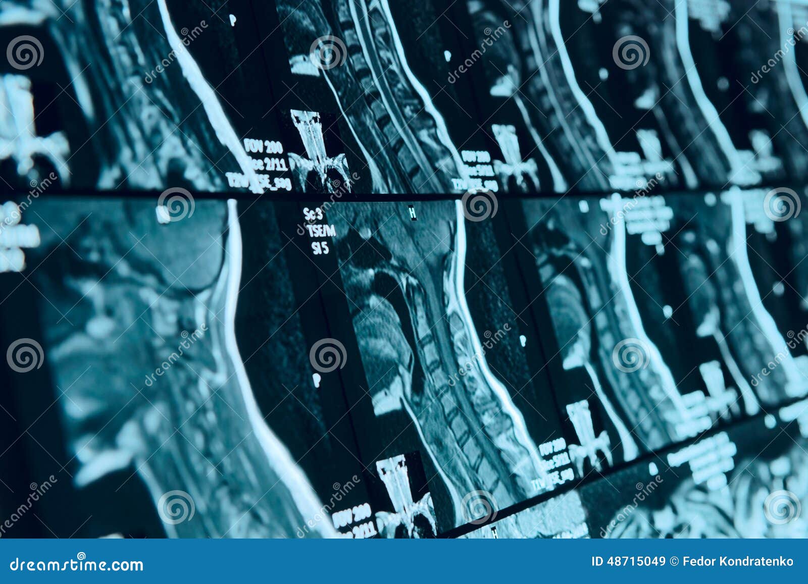 Head and Neck MRI Scan, Anonymized Stock Image - Image of medulla, axis ...