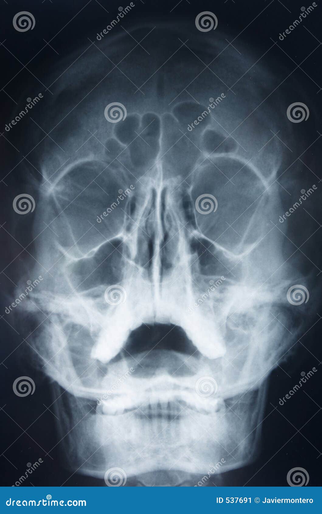 Head x-ray stock image. Image of maxilla, accident, harm - 537691