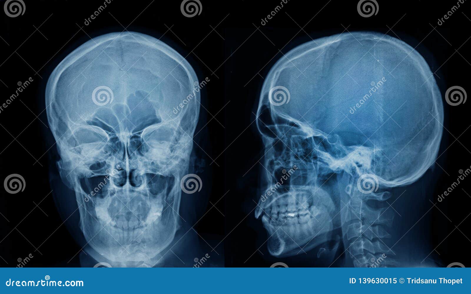 Head X-ray AP and Lateral View Stock Image - Image of examination, film ...
