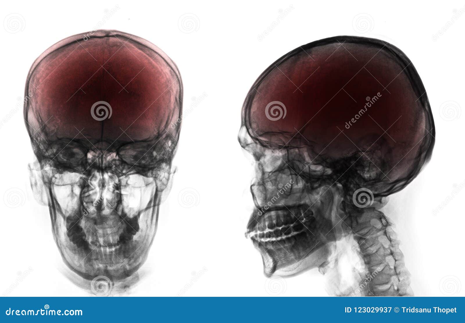 Head X-ray in Grey Tone and Red Hight Light at Brain Area Stock Image ...