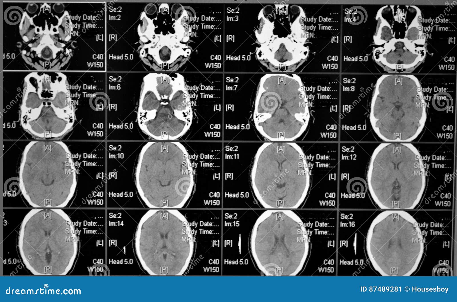 Head scan stock image. Image of diagnostic, angiogram - 87489281