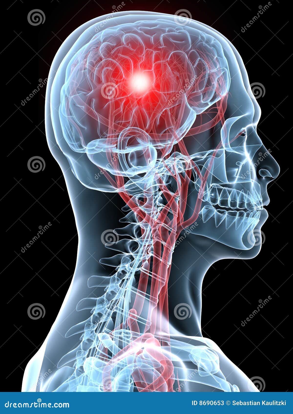 Headache / migraine stock illustration. Illustration of physiology ...