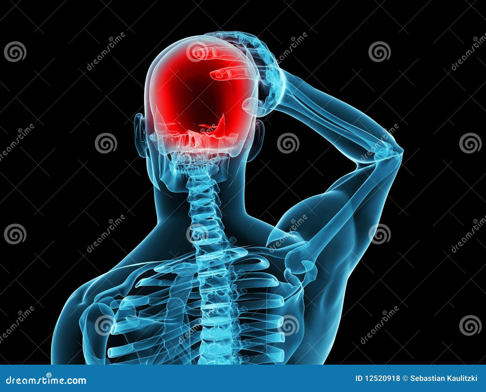 Headache/migraine Illustration Stock Illustration - Illustration of ...