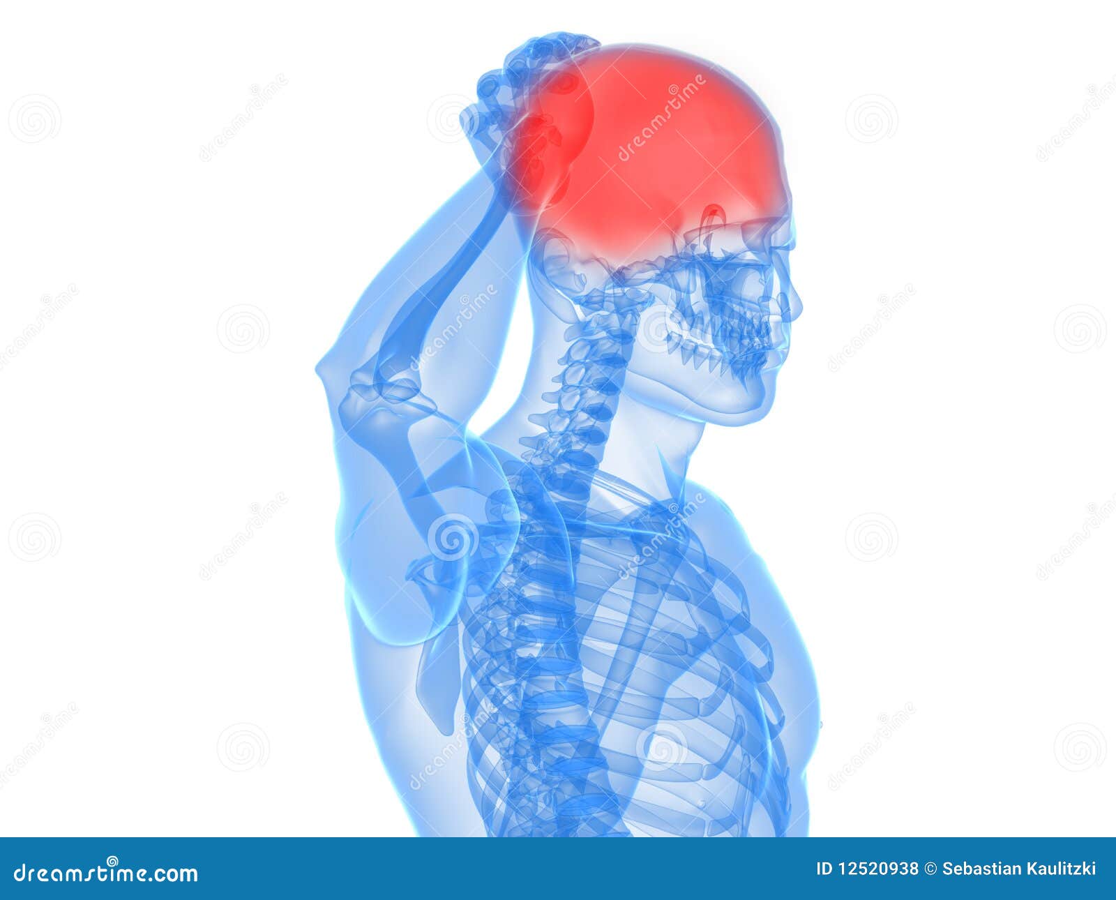 Headache/migraine Illustration Stock Illustration - Illustration of ...