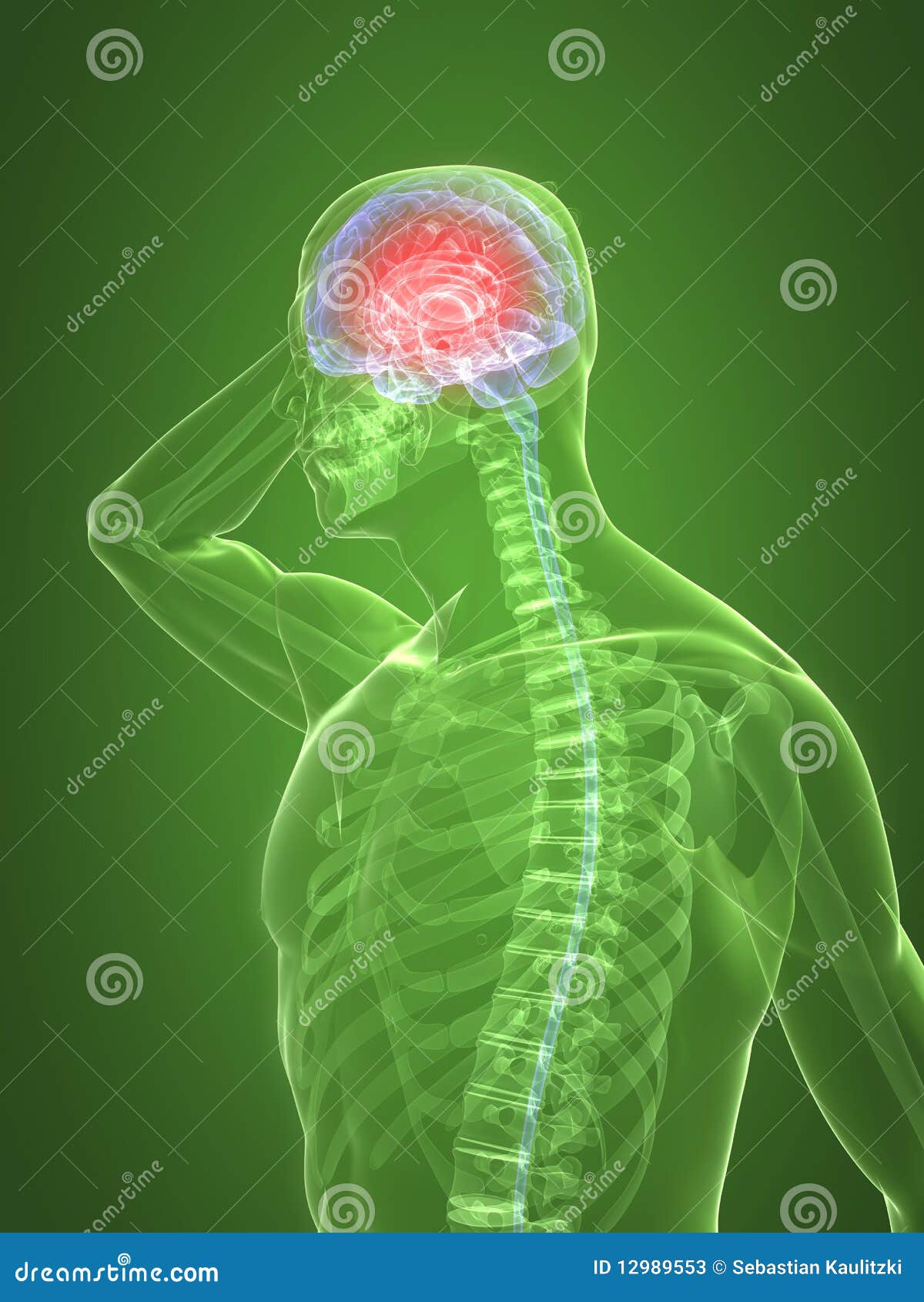 Headache/migraine Illustration Stock Illustration - Illustration of ...