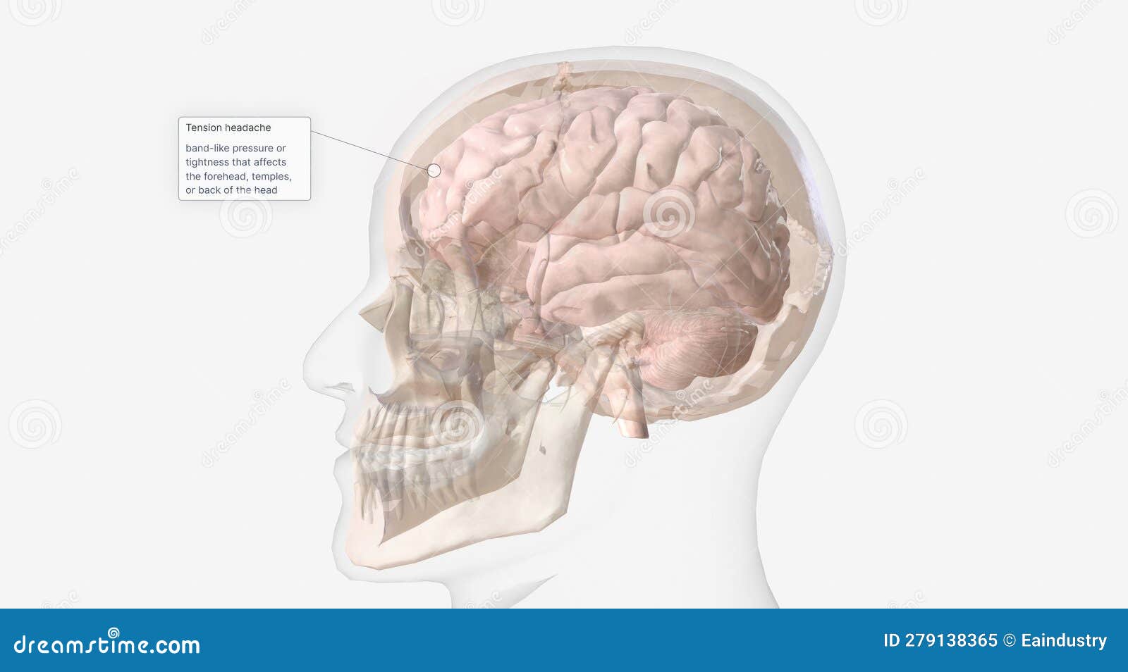 Headaches, Known As Tension Type, Affect the Forehead, Temples, and ...