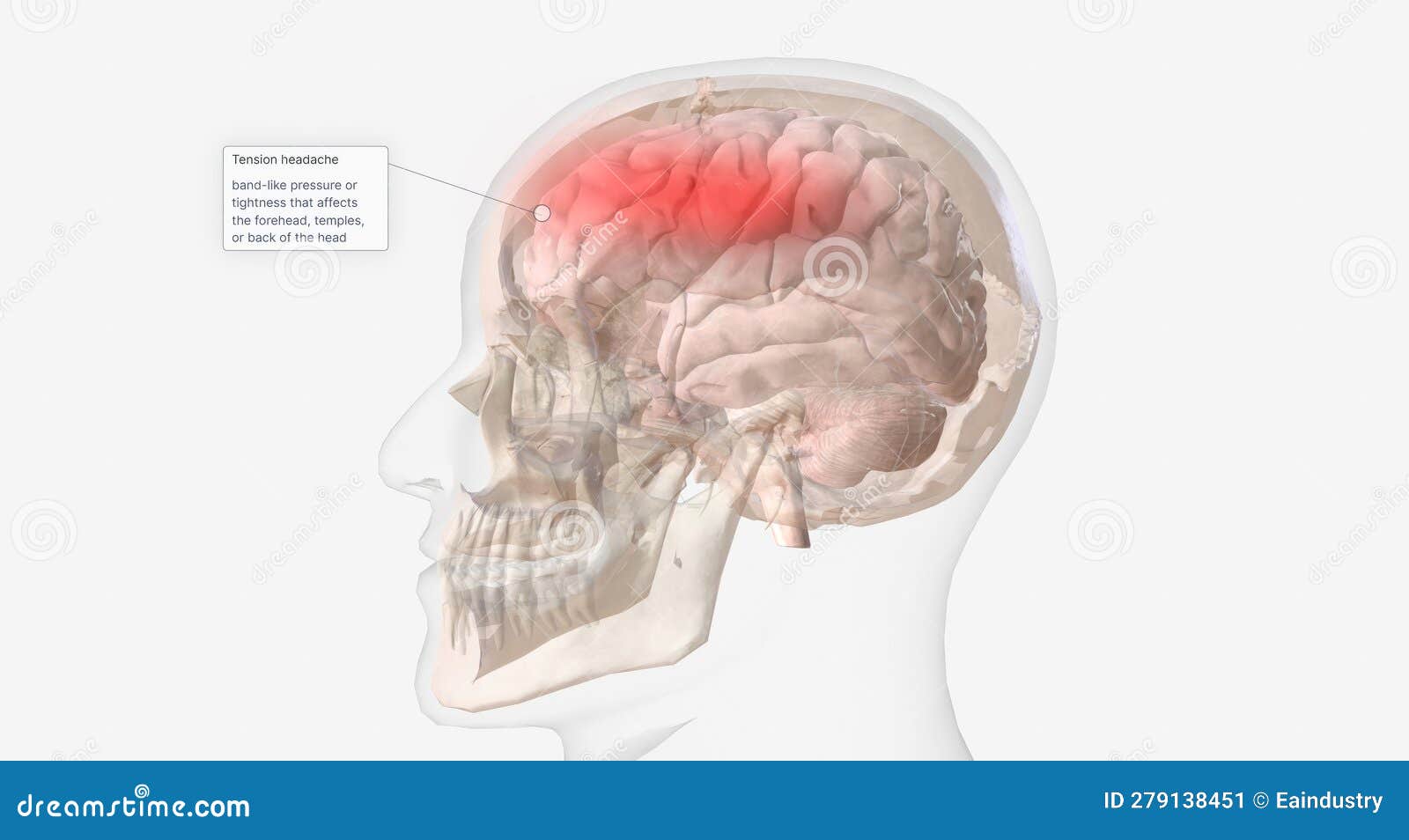 Headaches, Known As Tension Type, Affect the Forehead, Temples, and ...