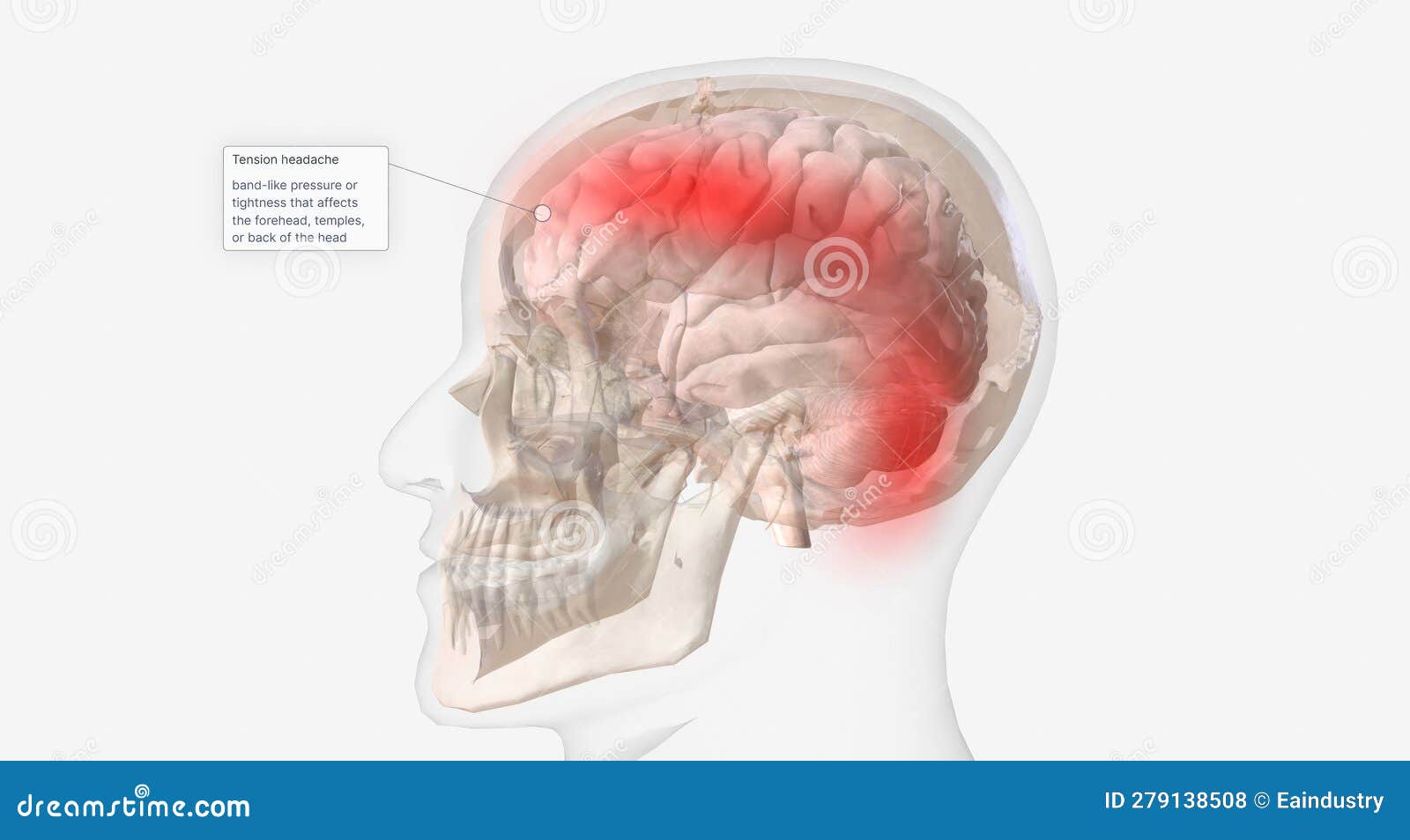 Headaches, Known As Tension Type, Affect the Forehead, Temples, and ...