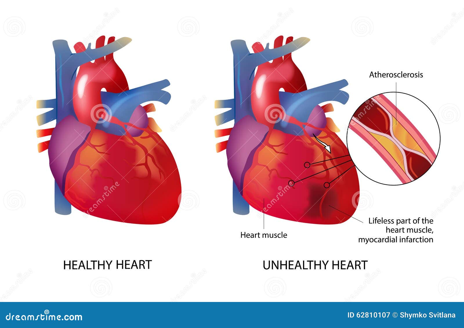 Healhty y corazón malsano stock de ilustración. Ilustración de tarifa ...