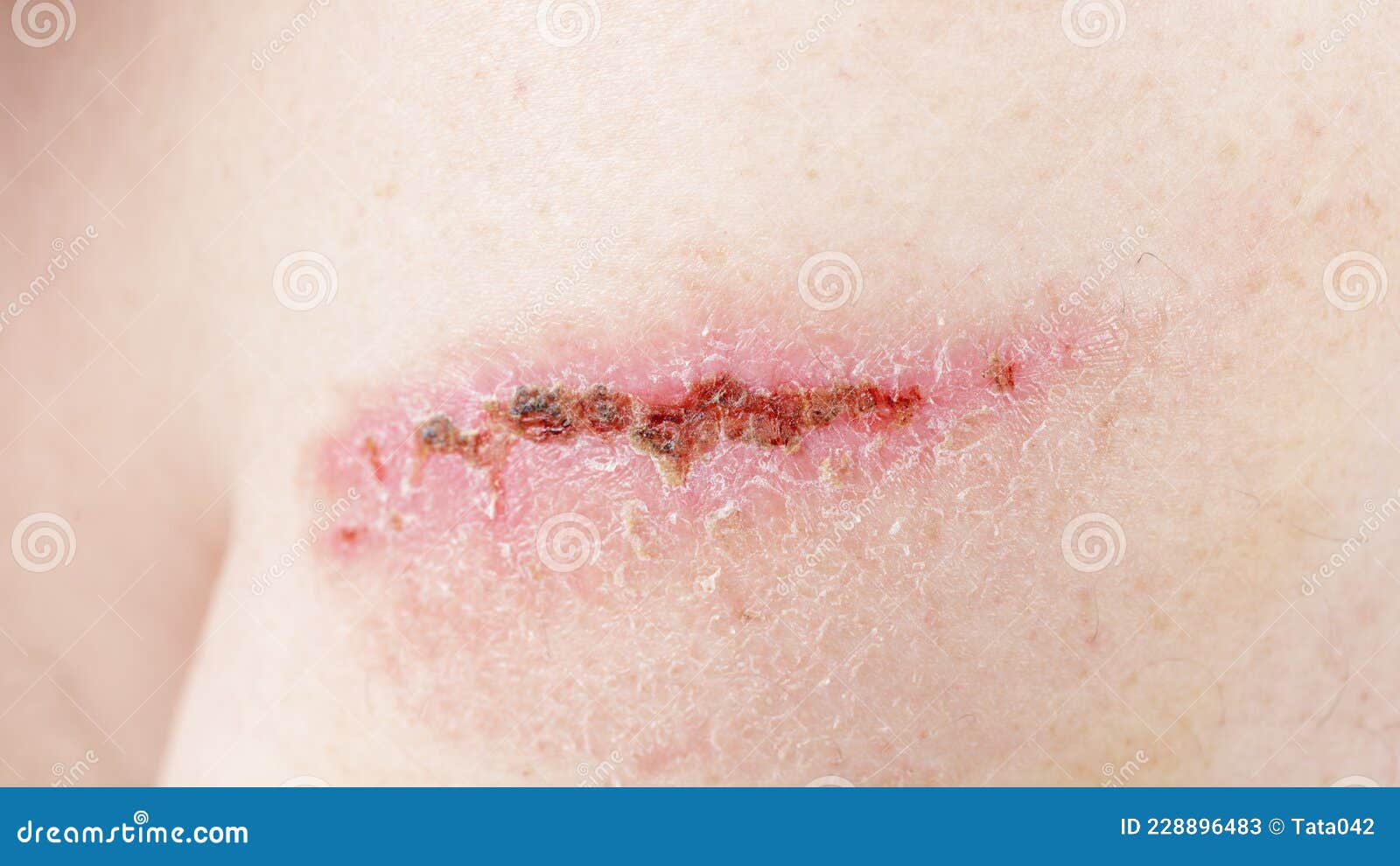 Healing Wound on Male Arm Closeup Stock Image - Image of cracks, design ...