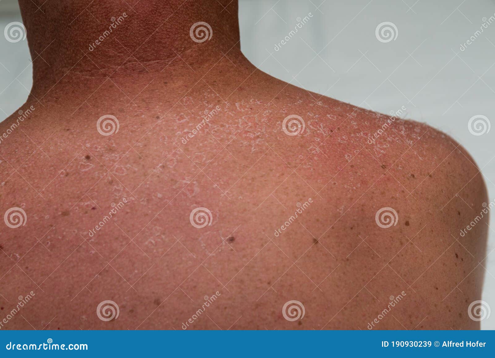 Sunburn on the back stock image. Image of weather, allergy - 190930239