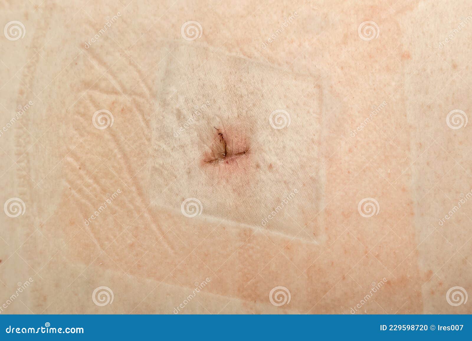 Healing Suture Scar after Surgery Stock Photo - Image of background ...