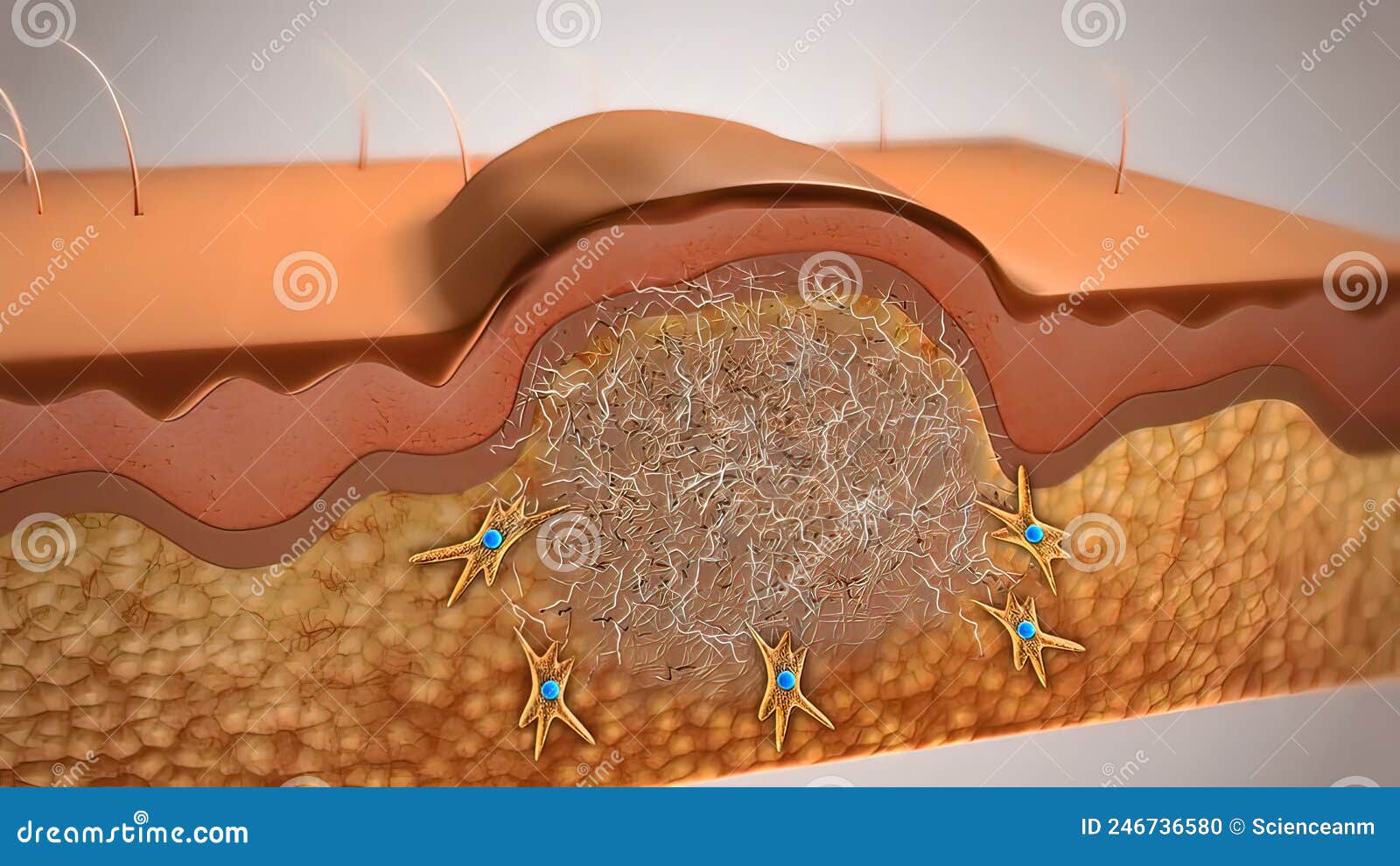Healing of the Wound on the Skin Stock Illustration - Illustration of ...