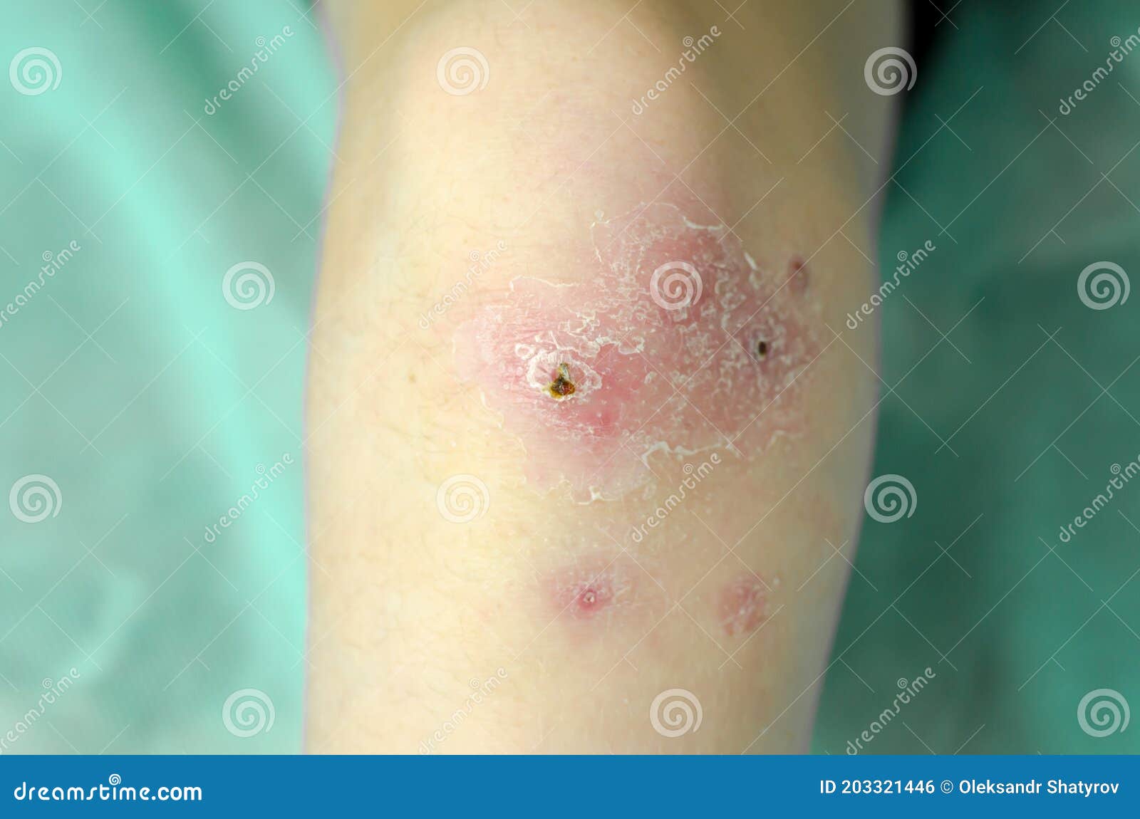 Healing Wounds on the Knee of a Child Stock Photo - Image of caucasian ...
