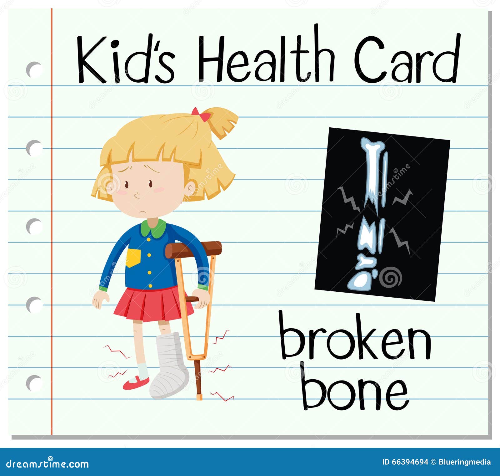 Broken Arm, Bone Fracture, Trauma, Orthopedic Plaster Cast. Sketch ...