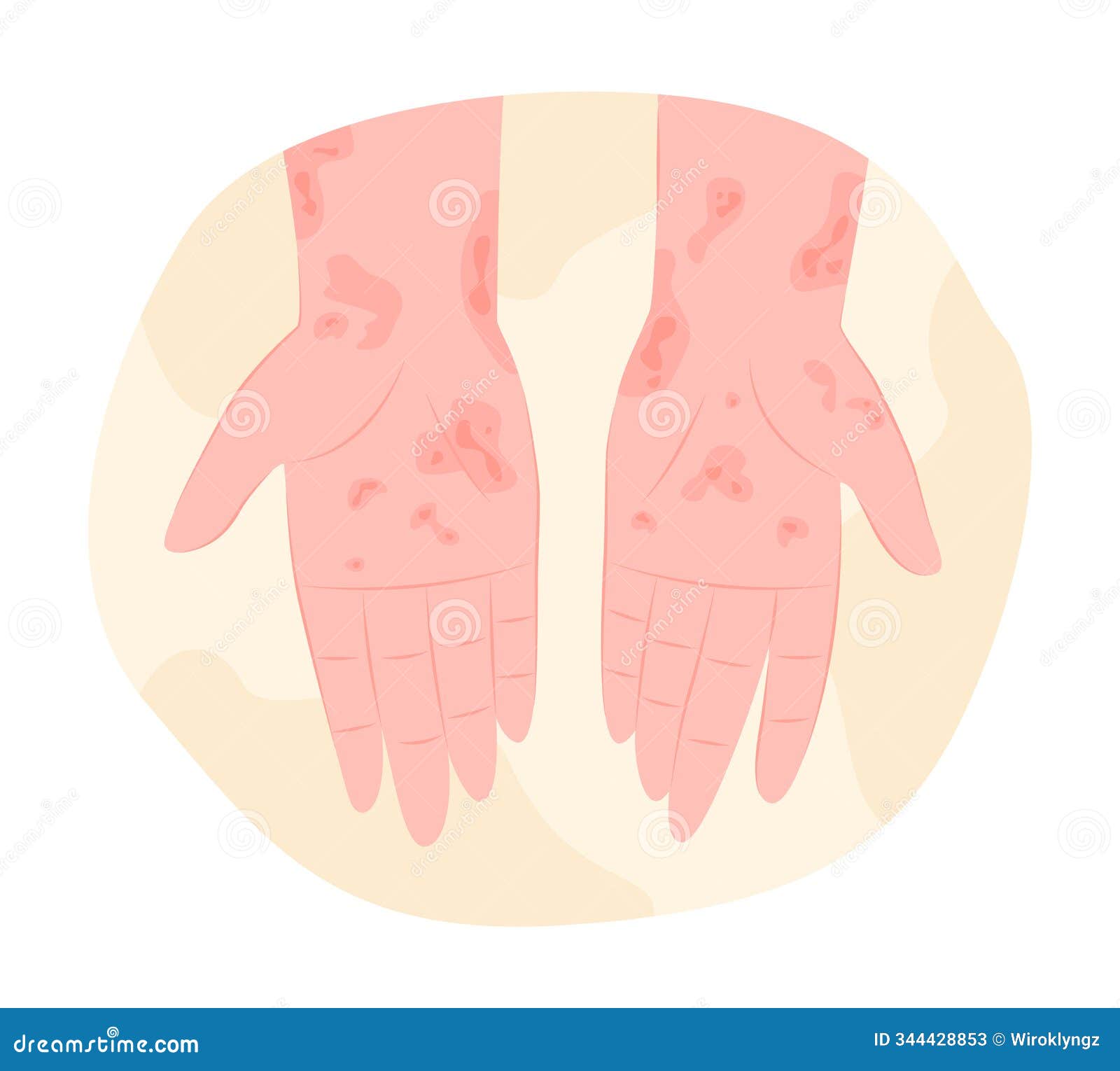 Skin Rashes Hiv Symptom Icon Doodle Illustration | CartoonDealer.com ...