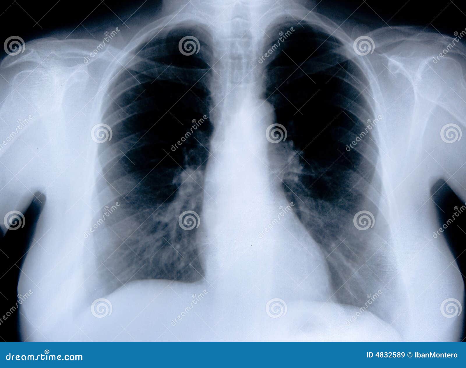 Health medical x ray stock image. Image of diagnosis, chest - 4832589