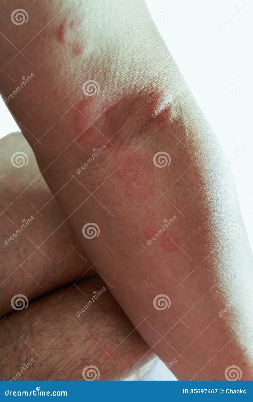 Health problem. stock image. Image of eczema, medical - 85697467