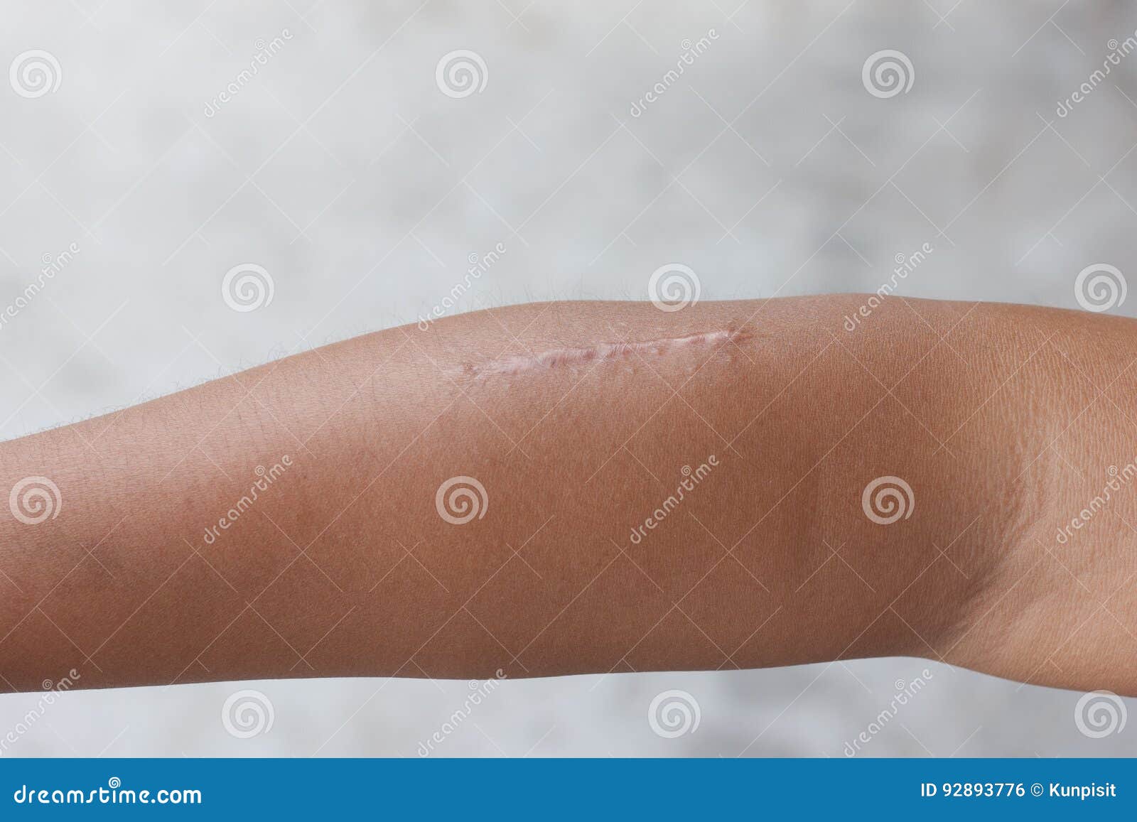 Health stock photo. Image of traces, wounds, clinic, marks - 92893776