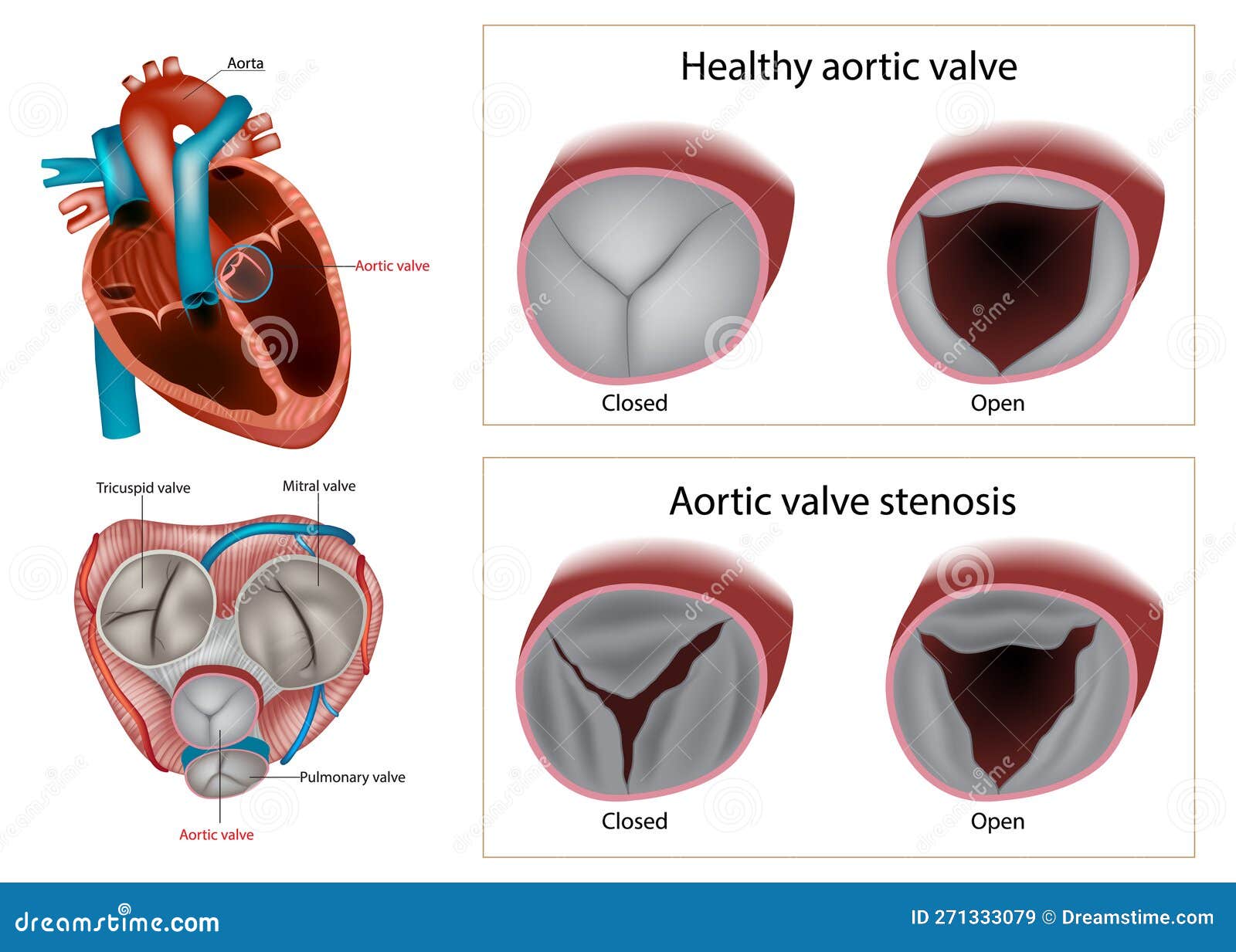 Healthy Aortic Valve Or Aortic Valve Stenosis Type Of Heart Valve