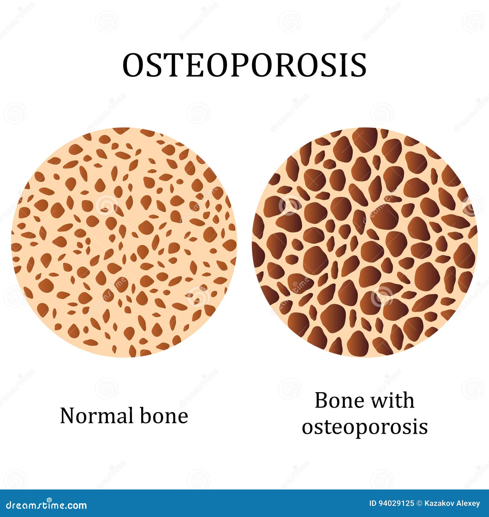 Healthy Bone And Osteoporosis Vector Illustration | CartoonDealer.com ...
